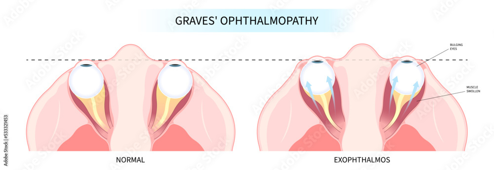 eye swollen with Hashimoto's thyroiditis and Graves' disease tumor ...