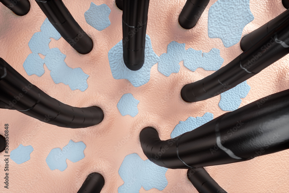 Fungal disease of the skin, dandruff on the scalp. An enlarged image of ...