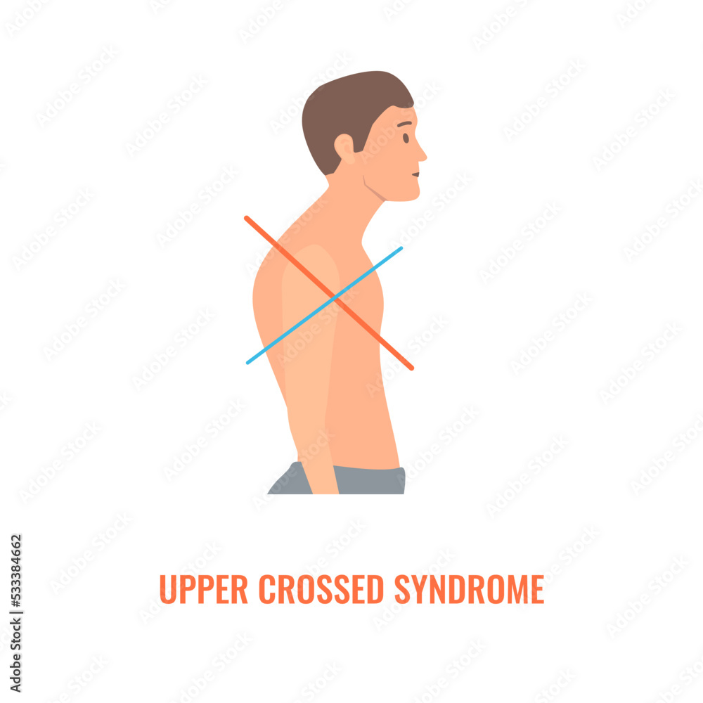 Upper crossed syndrome medical diagram. Crooked man with muscle ...
