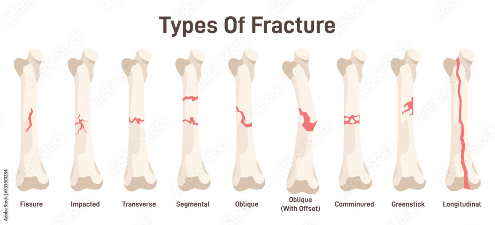 Types of bone fractures. Body injury, partial or complete break Stock ...
