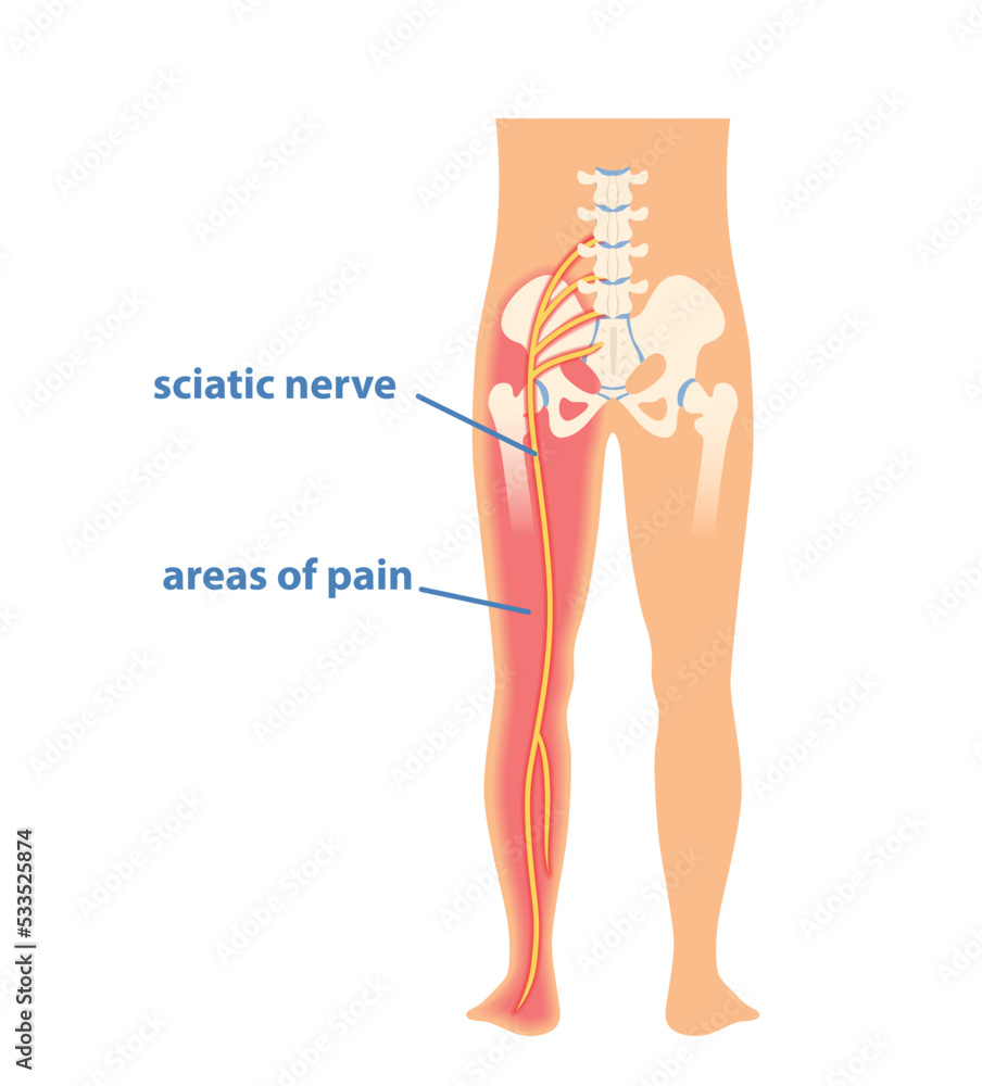 Sciatic nerve pinching. Human body silhouette with piriformis syndrome. Area of pain from hernia ...