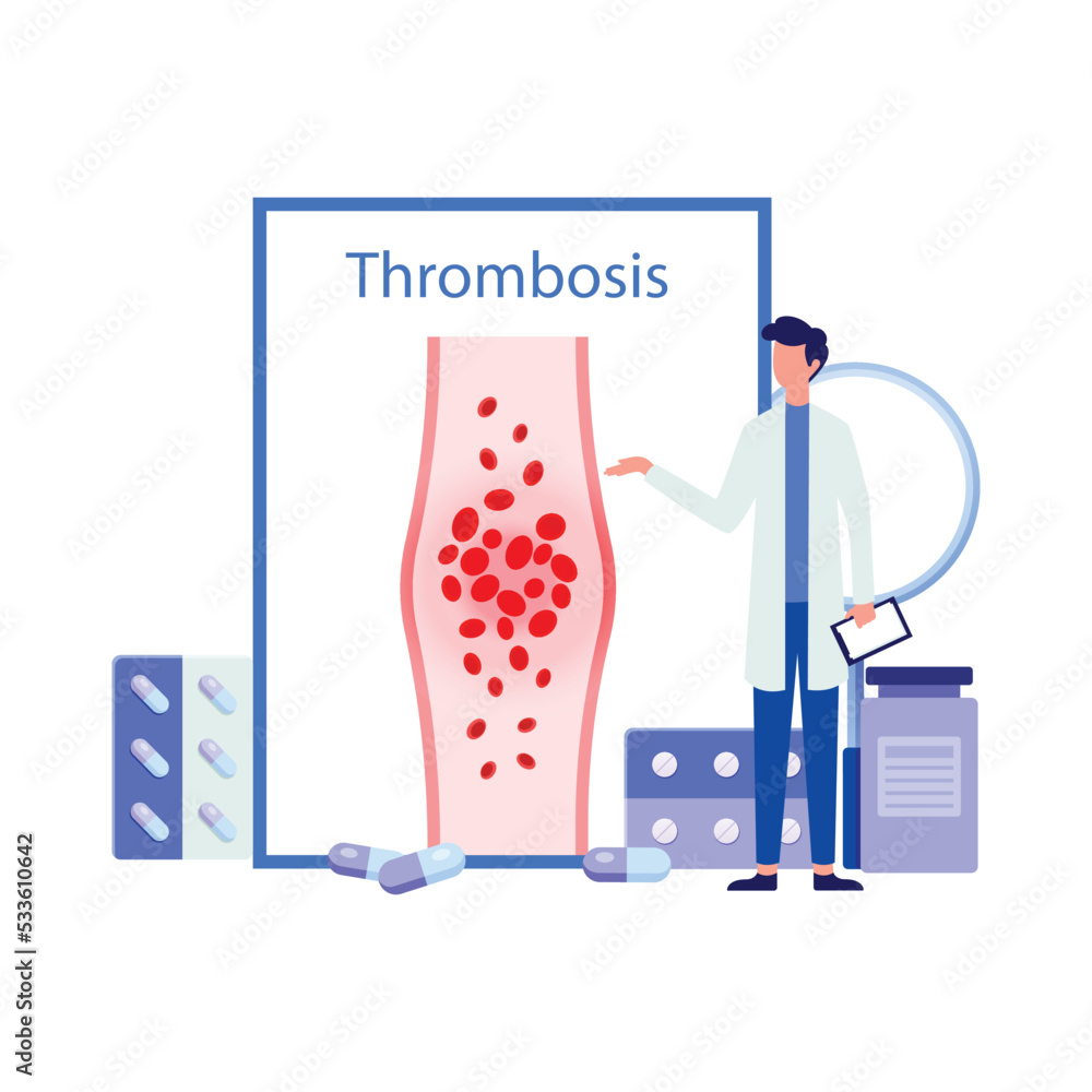 Medical Diagram of Deep Vein Thrombosis at leg area. Illustration about ...