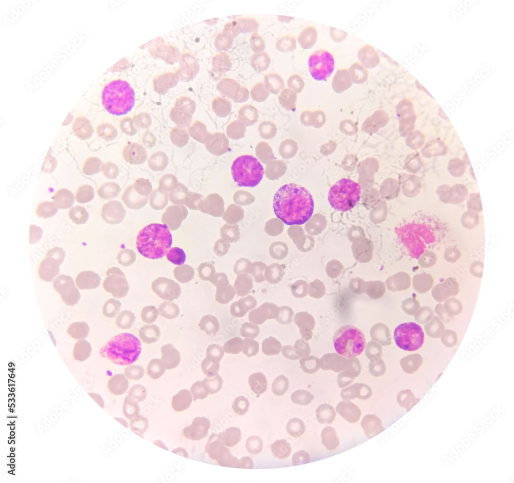Acute myeloid leukemia (AML) is a type of blood cancer. Microscopic ...