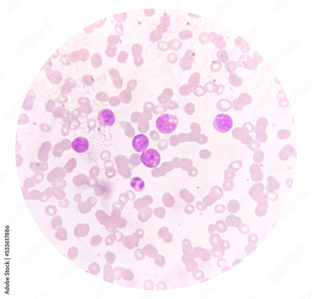 Acute myeloid leukemia (AML) cells analysed by light microscope Stock ...