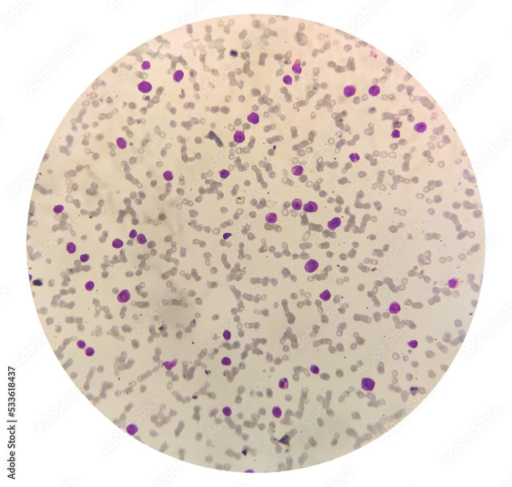 Microscopic image showing Chronic myeloid leukaemia (CML) is a type of ...