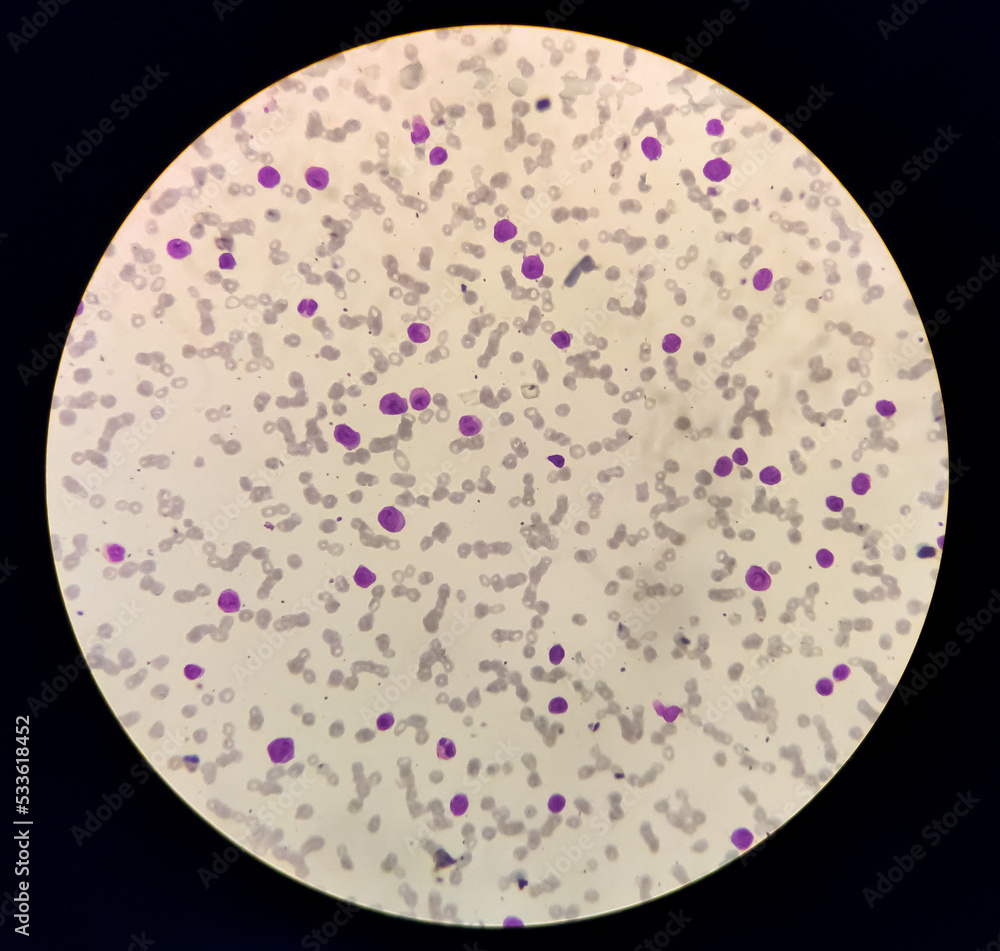Microscopic image showing Chronic myeloid leukaemia (CML) is a type of ...