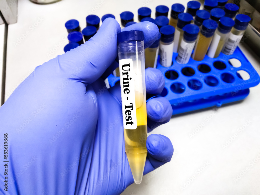 Urine specimen for doping drugs test of marijuana and cocaine. To ...