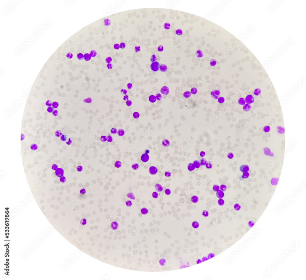 Burkitt's lymphoma cells, is a cancer of the lymphatic system, a ...