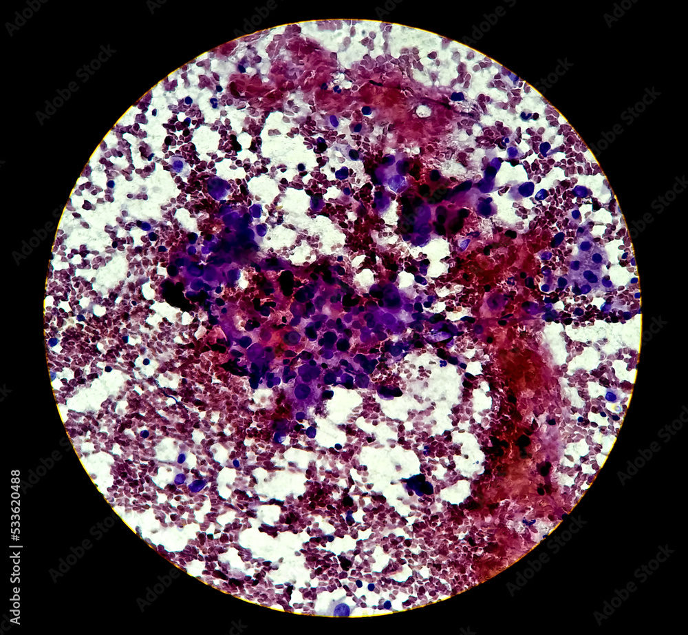 Metastatic Squamous cell carcinoma of a human, photomicrograph as seen ...