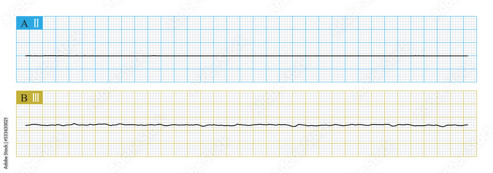 Figure A shows total cardiac arrest, and Figure B shows ventricular ...