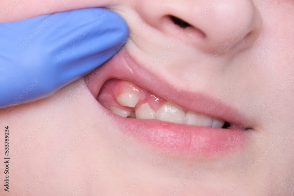 A 12 year old teeth with malocclusion close up, orthodontic problem and ...