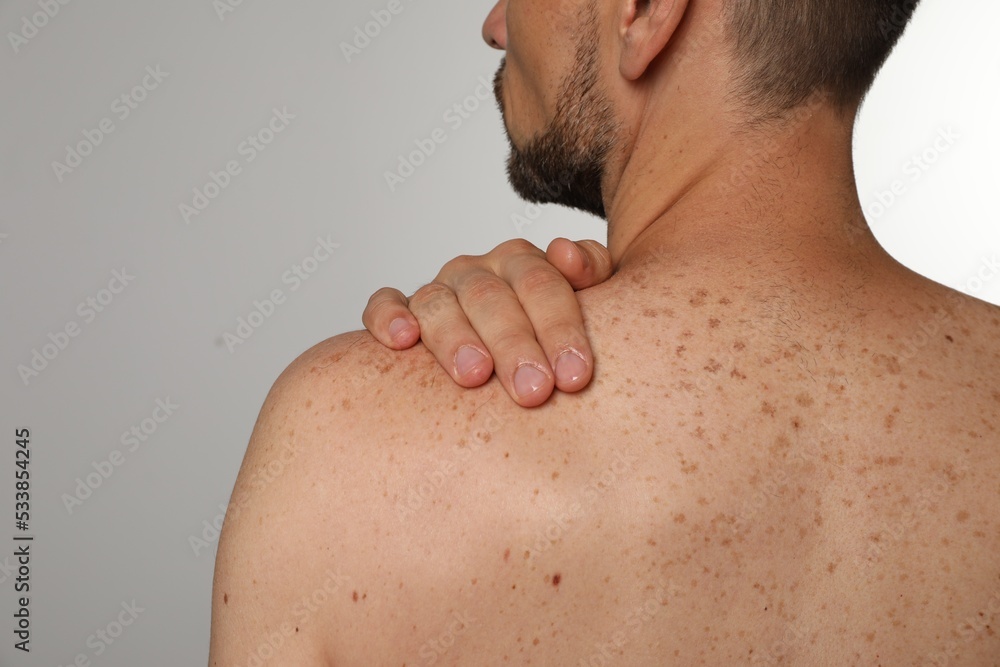 Closeup of man`s body with birthmarks on light grey background, back ...