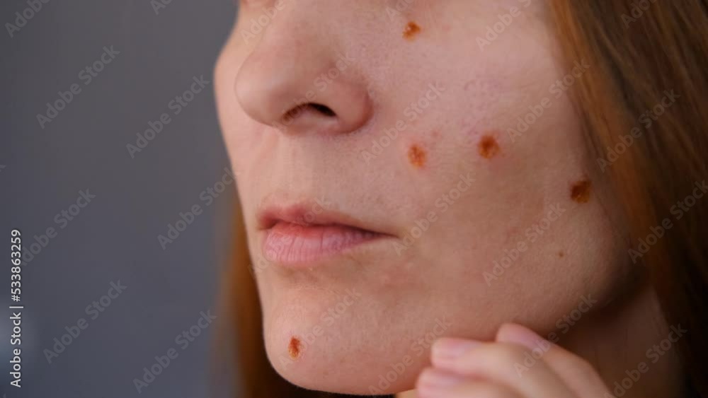 Woman with burns on her face after removing moles cosmetic aesthetic ...