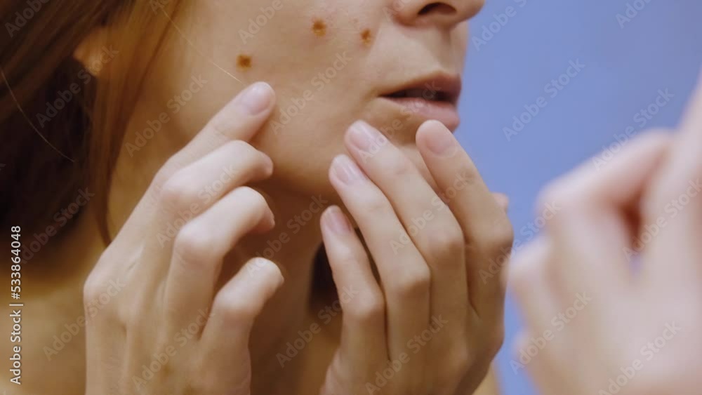 Woman with burns on her face after removing moles cosmetic aesthetic ...