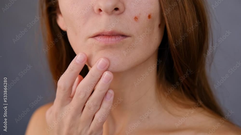 Woman with burns on her face after removing moles cosmetic aesthetic ...