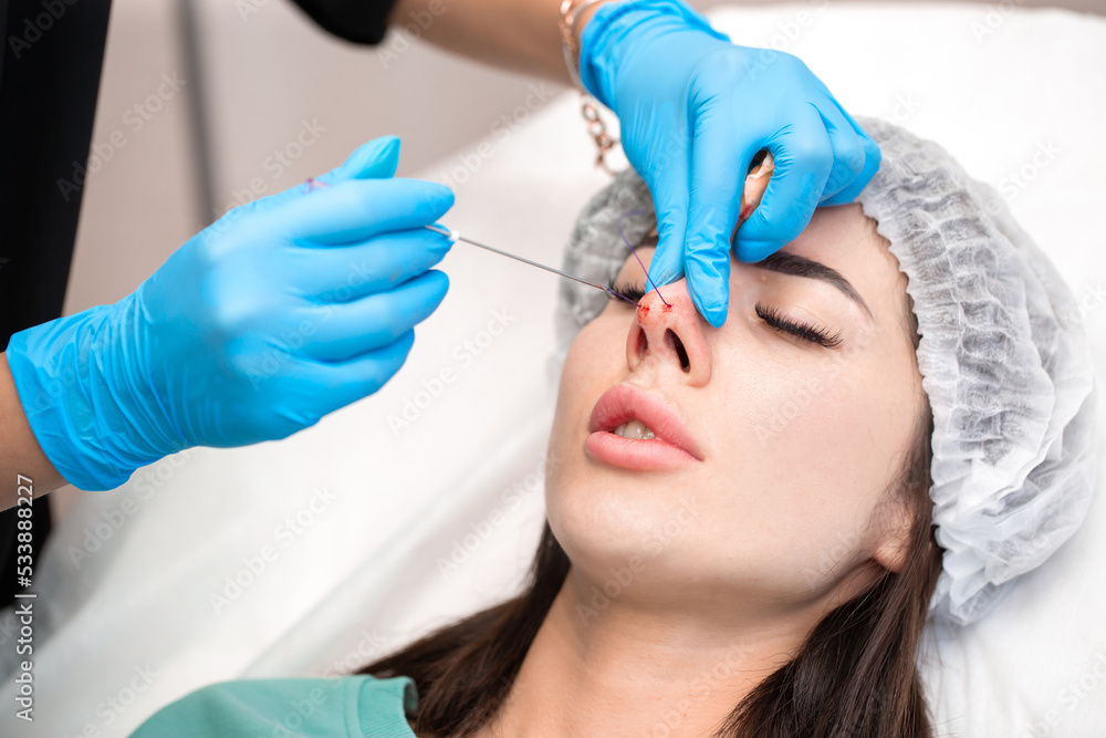 Cosmetic procedure for non-surgical rhinoplasty. The beautician inserts ...
