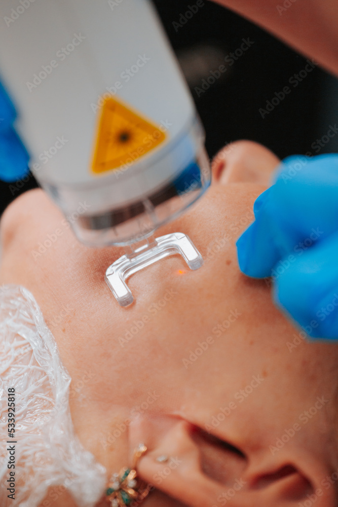 Performing laser resurfacing using an ablative laser on the skin of a ...