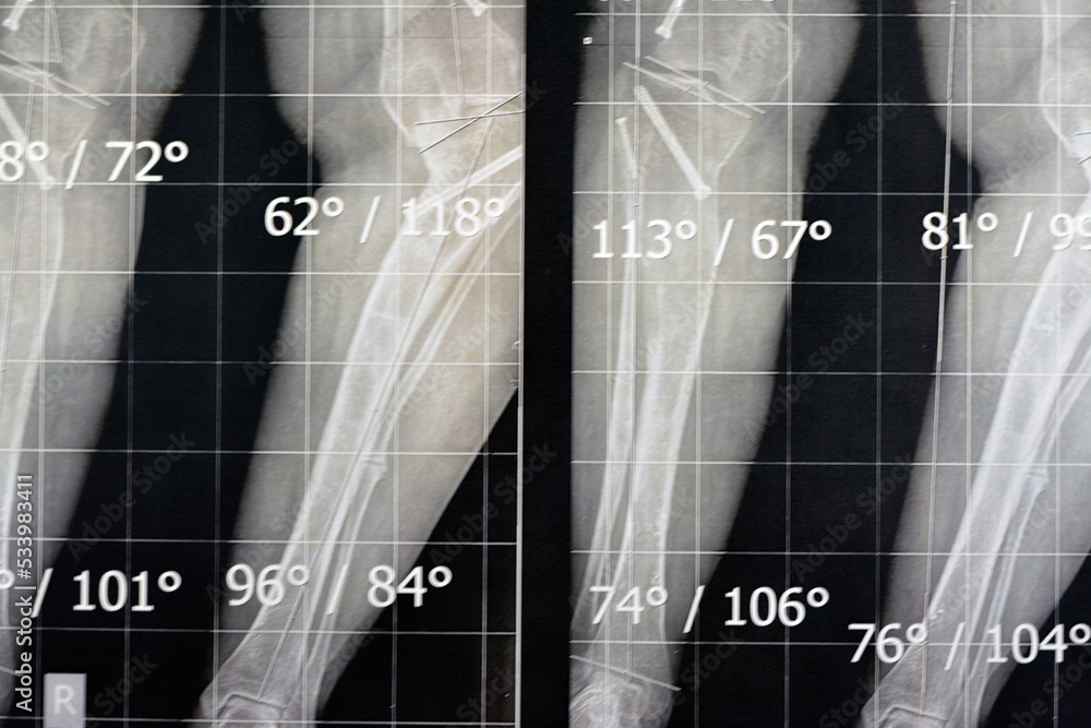 Plain x ray long film standing position showing both legs with ...