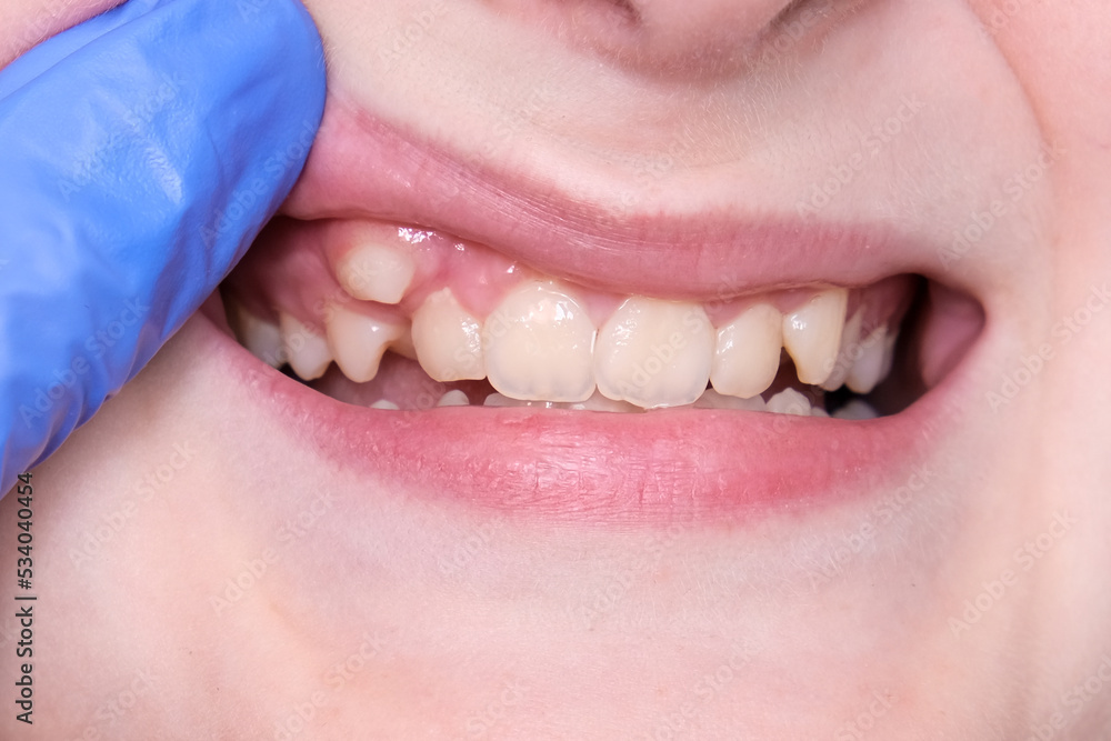 A 12 year old teeth with malocclusion close up, orthodontic problem and ...