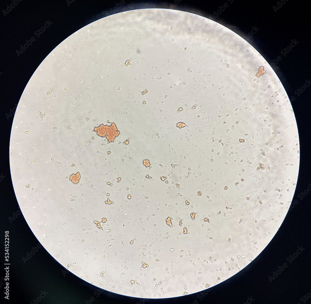 Red blood cell agglutination Crossmatching Incompatible donor. Stock ...