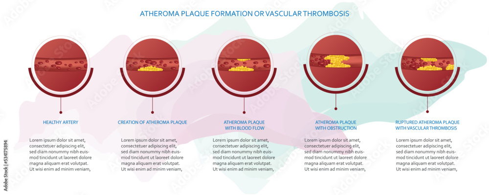 Infographics atheroma plaque formation, vascular thrombosis. Stock ...