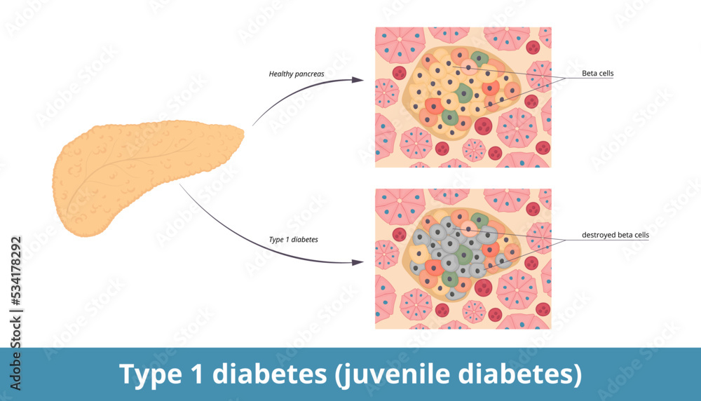 Type 1 diabetes (juvenile diabetes). Diabetes mellitus type 1 ... Type 1 diabetes (juvenile diabetes). Diabetes mellitus type 1 ...