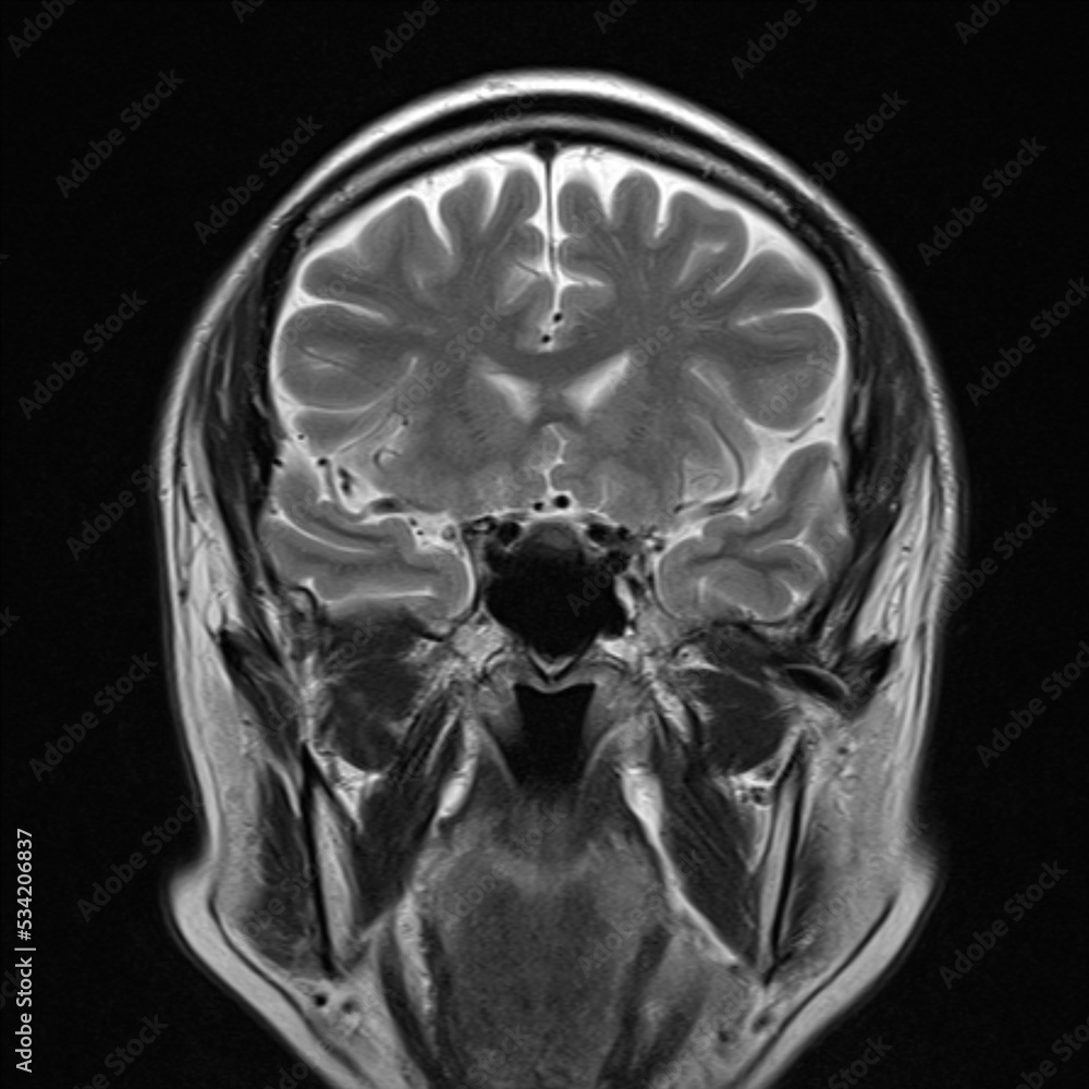 normal T1 coronal plane brain Magnetic resonance imaging (MRI) foto de ...