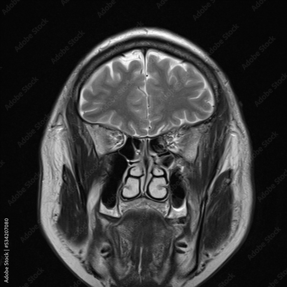 normal T1 coronal plane brain Magnetic resonance imaging (MRI) Stock ...