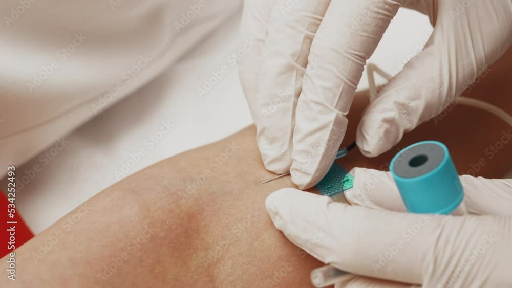 Arterial blood sampling. Stock Video | Adobe Stock