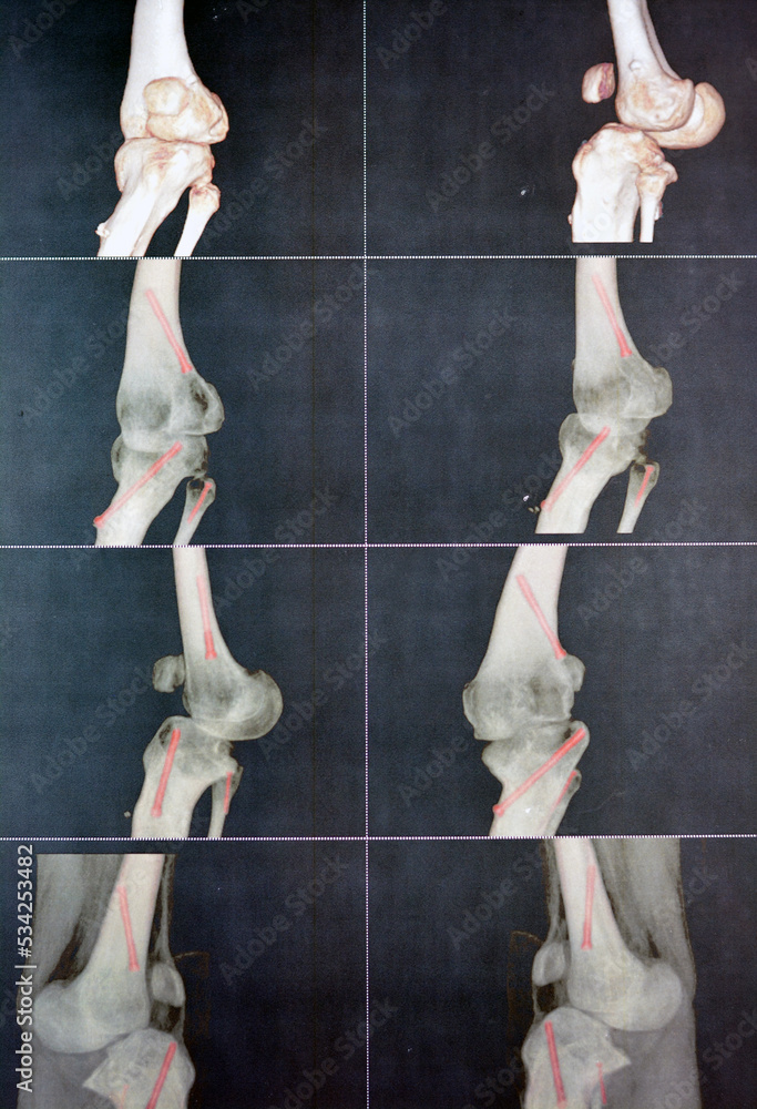 CT angiography of the left knee 3D view showing patent popliteal artery ...