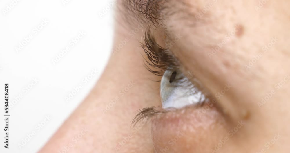 woman eye with corneal dystrophy, keratoconus, thinning of the cornea ...