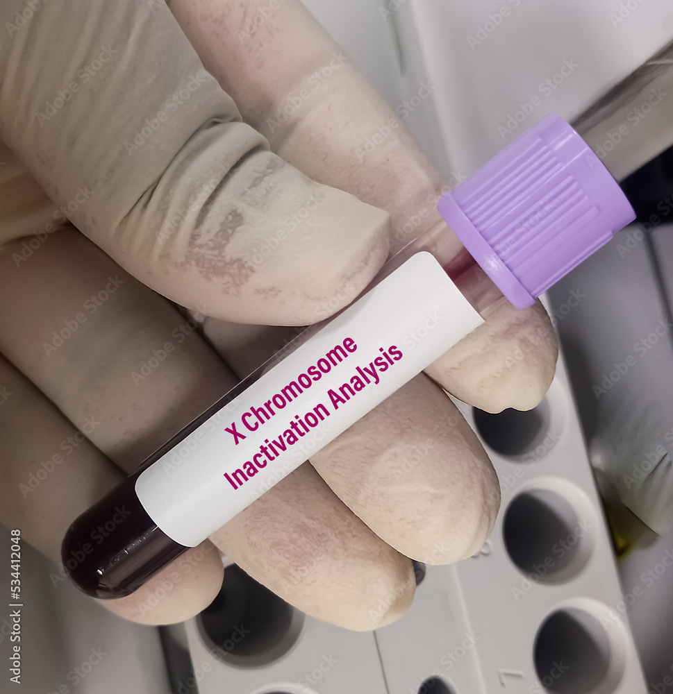 Blood sample for X-Chromosome Inactivation Analysis for female carriers ...