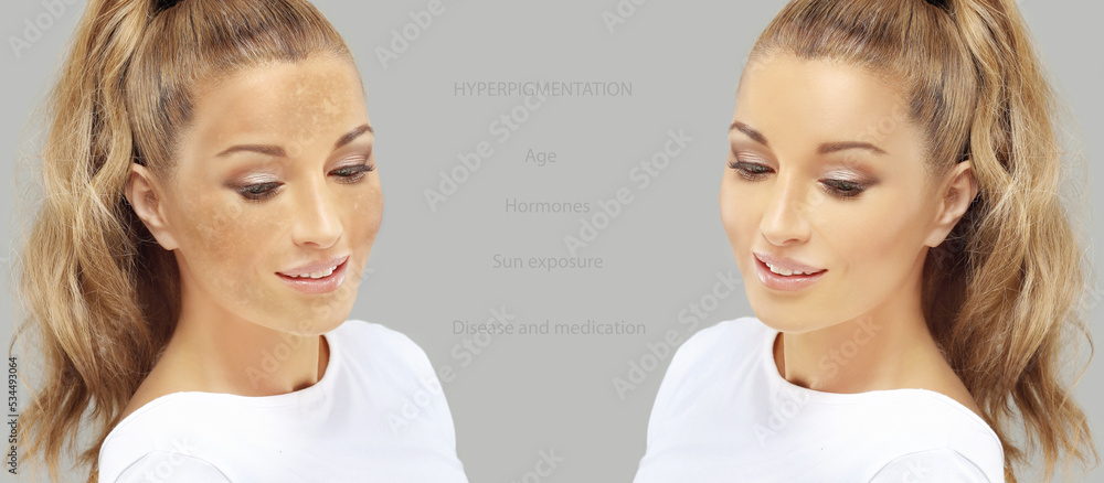 Dark spots, freckles,hyperpigmentation(melasma or chloasma),concept ...