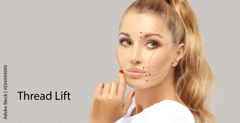 Thread Lift ,markup, thread-lift procedure for facial rejuvenation ...