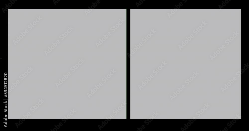 Angiogram balloon dialysis catheter inflated at Arteriovenous (AV ...