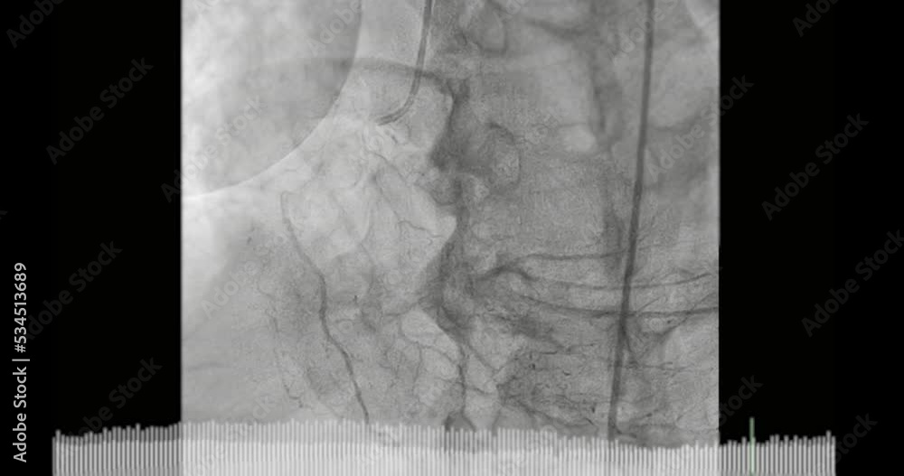 Cardiac catheterization showing coronary arteries for diagnosis cardiac ...