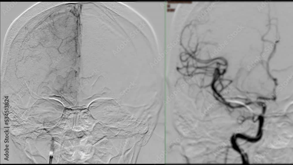 Vidéo Stock Cerebral angiography from Fluoroscopy in intervention ...