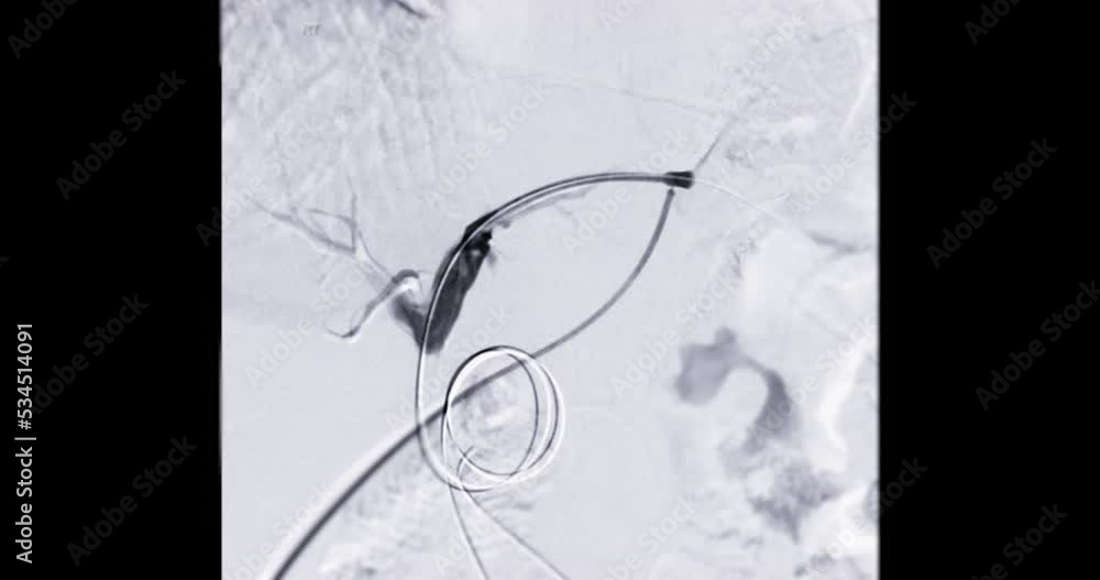 Vídeo do Stock: Percutaneous Transhepatic Biliary Drainage (PTBD) is a ...