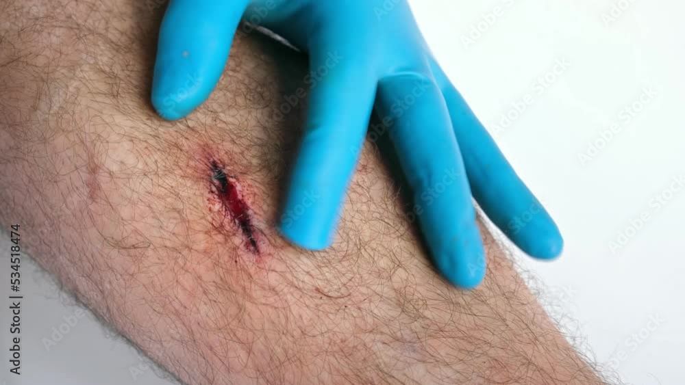 The Wound on a Leg of Young Man. Close Up. Open Red Wound, flows blood ...