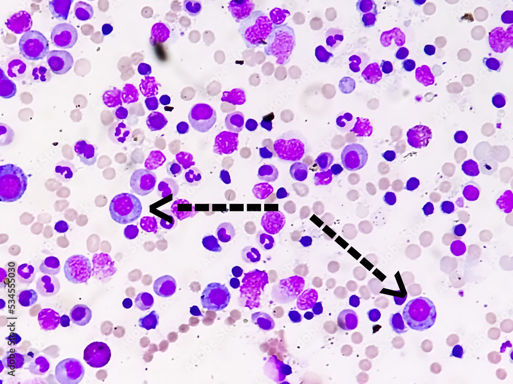 Microscopic image of bone marrow. Plasma cell dyscrasia or Multiple ... Microscopic image of bone marrow. Plasma cell dyscrasia or Multiple ...
