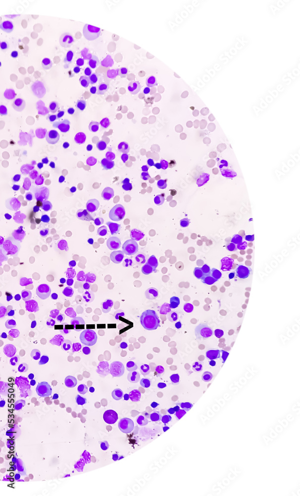 Microscopic image of bone marrow. Plasma cell dyscrasia or Multiple ...