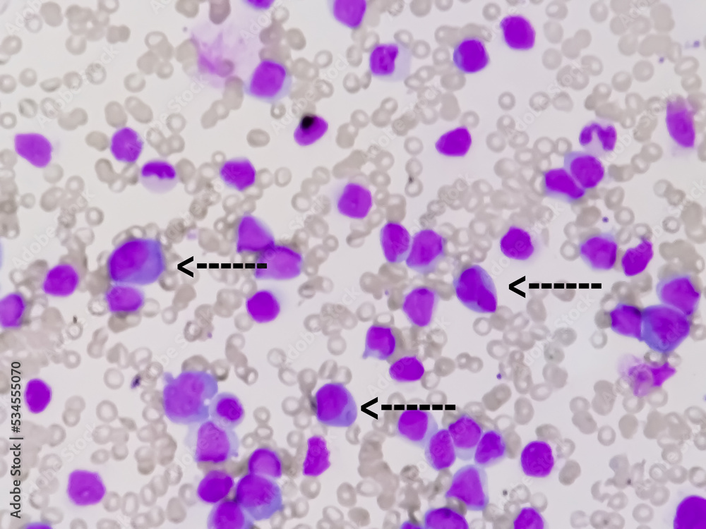 Plasma Cell In Multiple Myeloma
