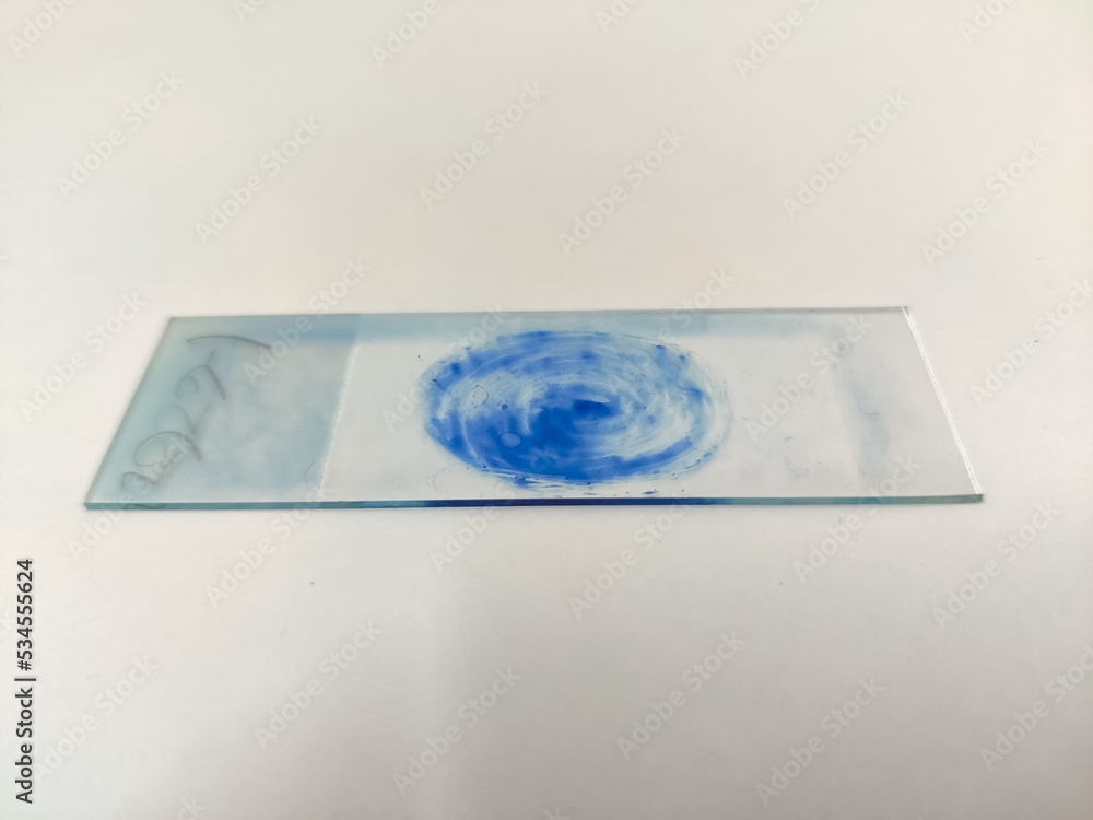 Sputum or phlegm smear AFB (auromin O) and Fluorescent (FM) stained ...