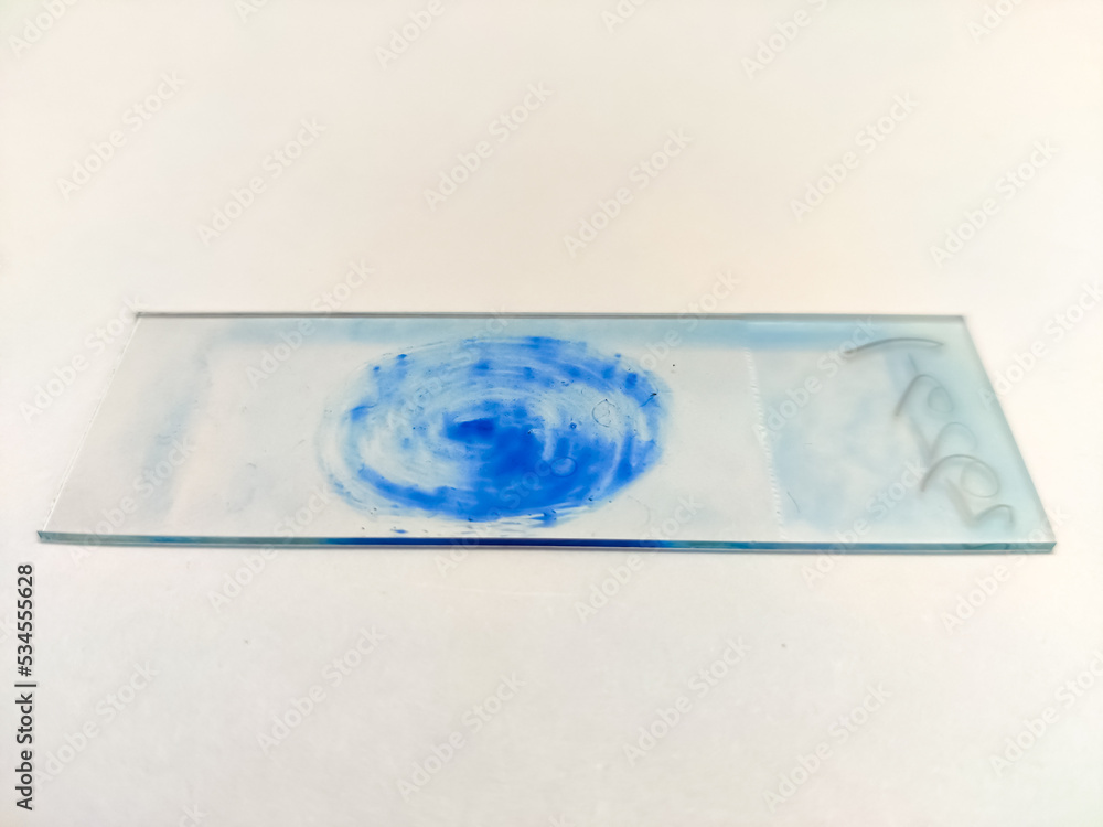 Sputum or phlegm smear AFB (auromin O) and Fluorescent (FM) stained ...