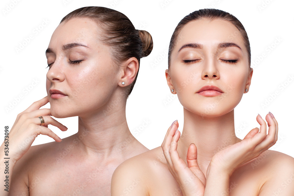 Young woman before and after acne treatment and retouch. Stock Photo ...