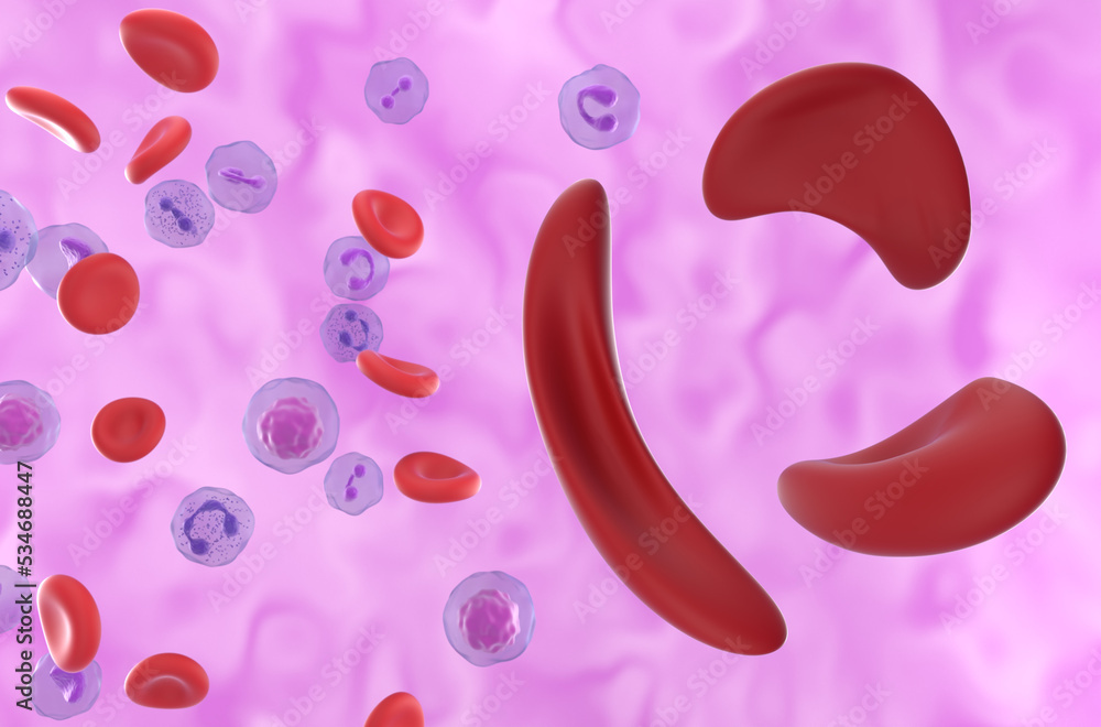 Sickle cell Anaemia - Sickle cell disease SCD - cells in the blood flow ...