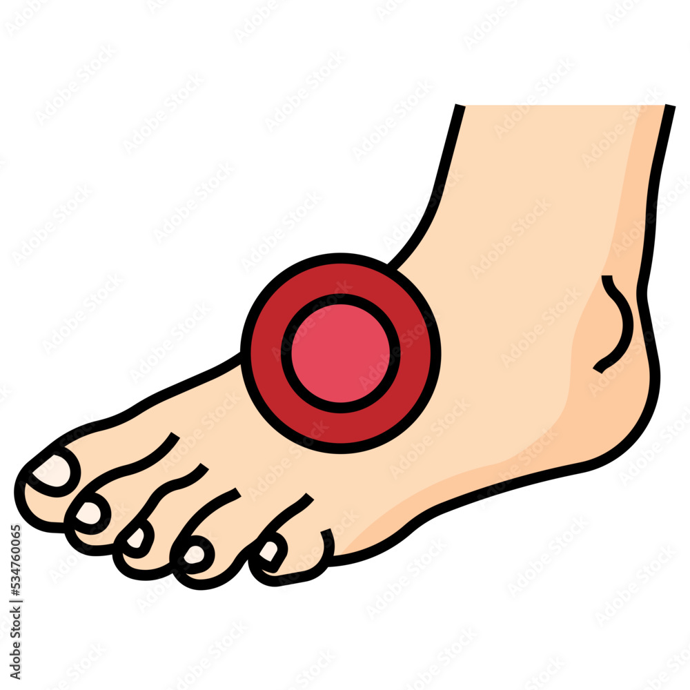 extensor tendonitis Stock Vector | Adobe Stock