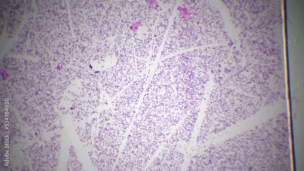 Smear of human blood under microscope with 40 times magnification on ...