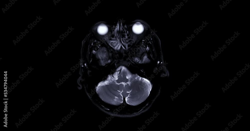 MRI of the brain in axial T2 Fat suppression showing anatomy of the ...