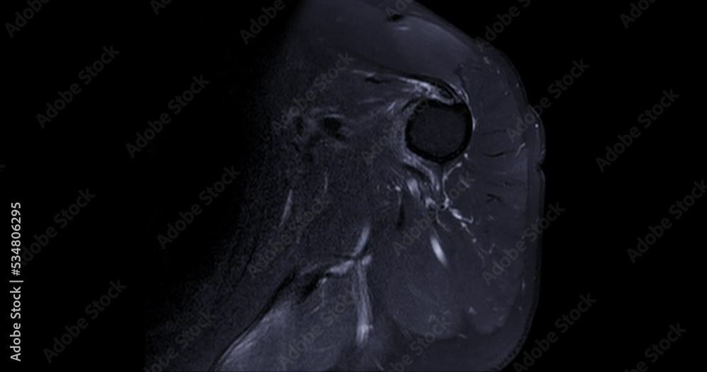 Magnetic resonance imaging (MRI) of Shoulder Joint for diagnostic ...